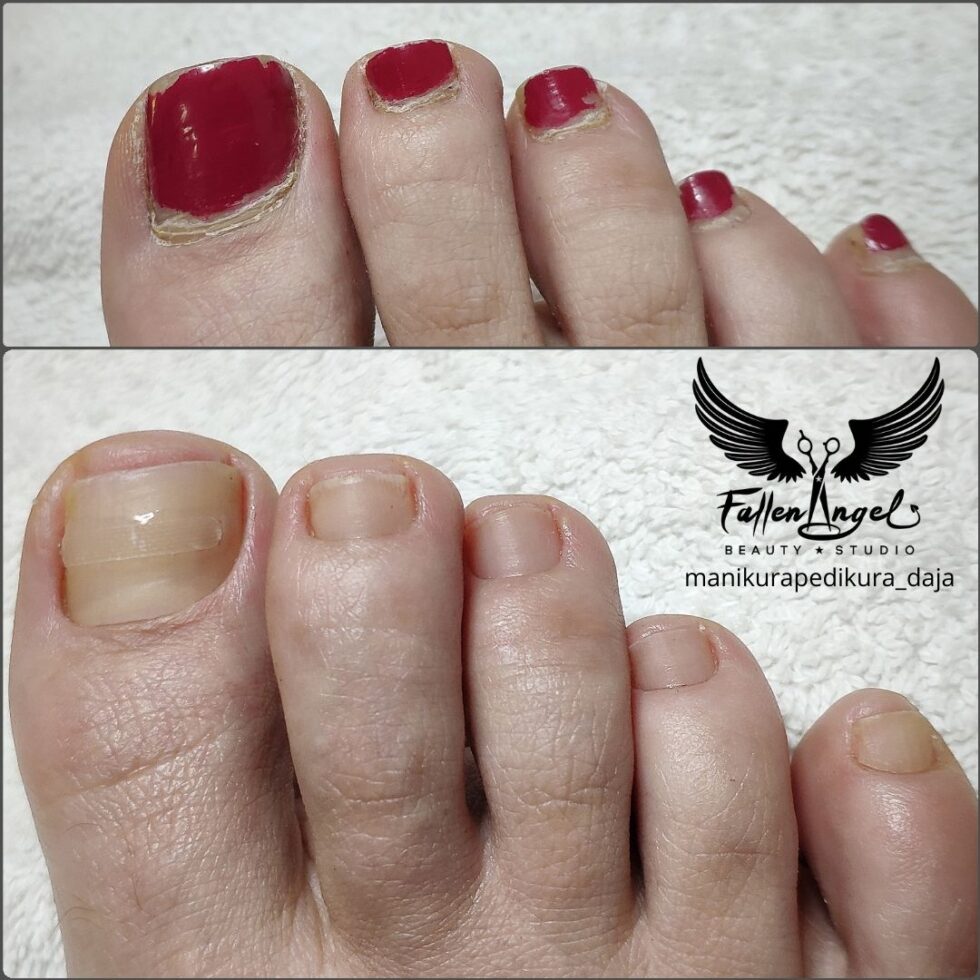 Zarostlý nehet Ortonyxie | Manikúra Pedikúra Dája