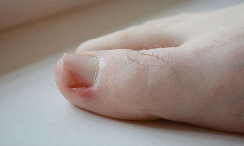 5 rad jak na zarostlý nehet | Manikúra Pedikúra Dája