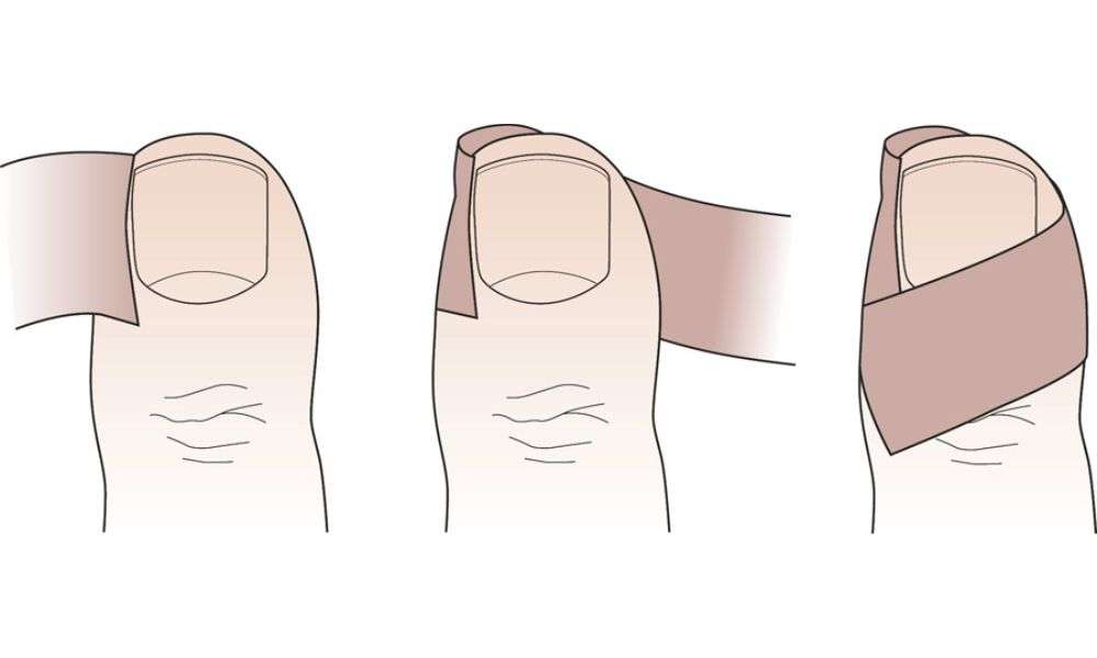 Zarostlý nehet - tejpování | Manikúra Pedikúra Dája